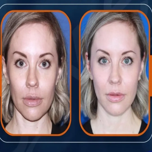 Facelift in Turkey: Cost, Packages and Surgeons